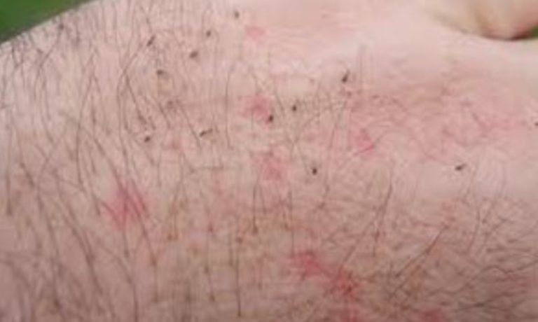 Sand fly bite - Clovelly News